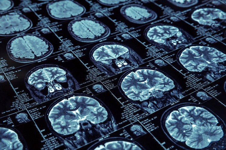 Maladie d'Alzheimer : les plaques amyloïdes seraient inoffensives